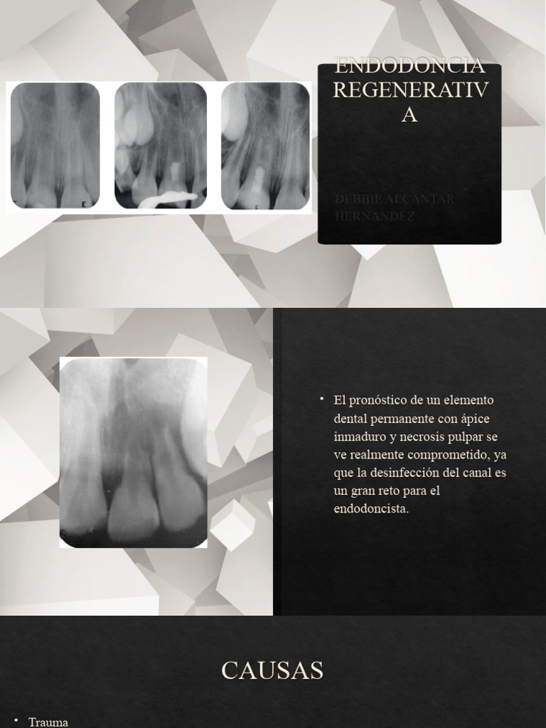Endodoncia Regenerativa | PDF | Diente | Medicina CLINICA