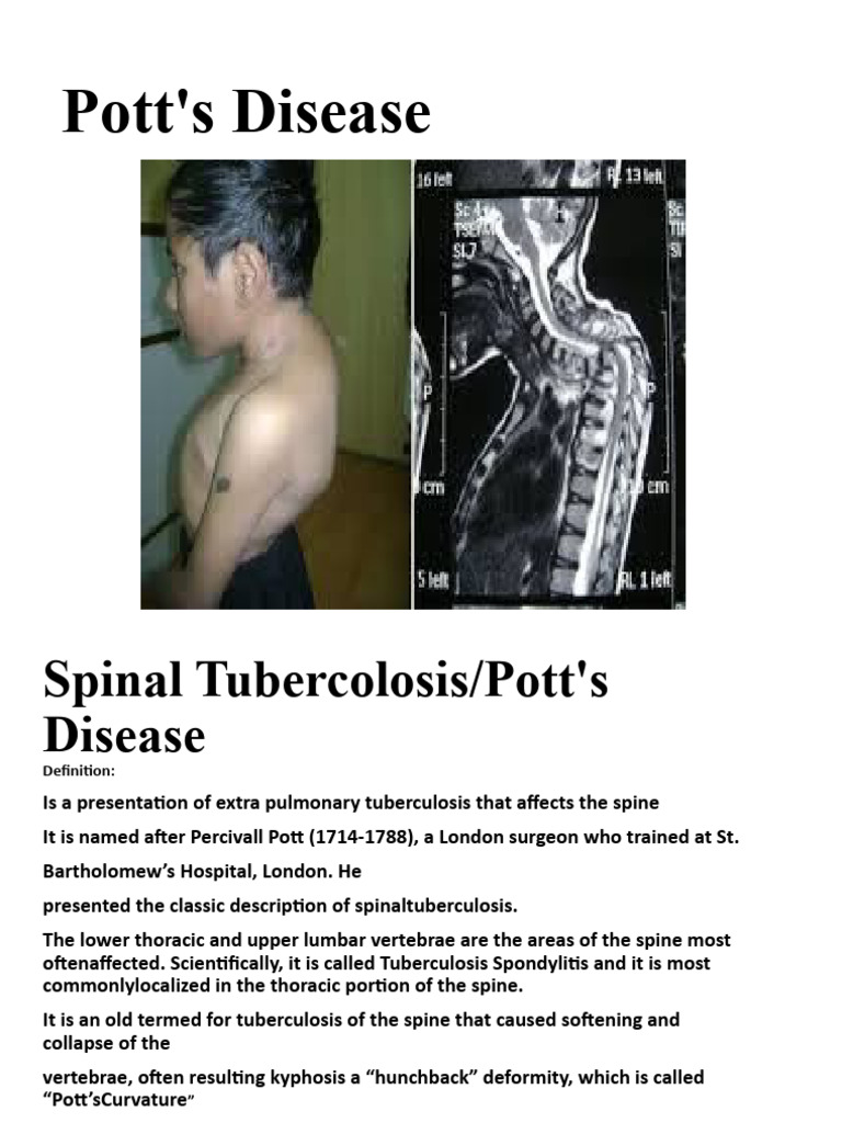 Pott's Disease-WPS Office | PDF | Vertebral Column | Tuberculosis