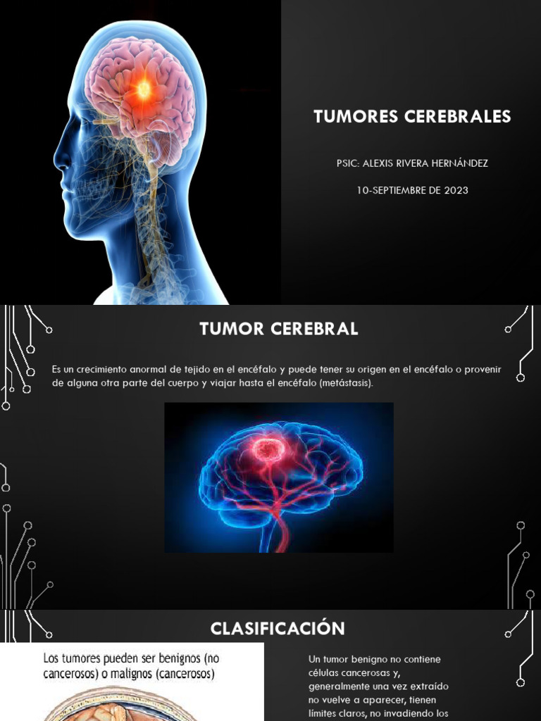 EXPO CÁNCER Cerebro | PDF | Cáncer | Neoplasias