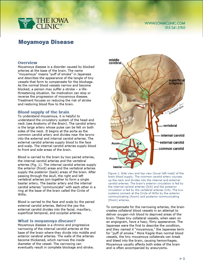 Moyamoya Disease | PDF | Stroke | Angiography