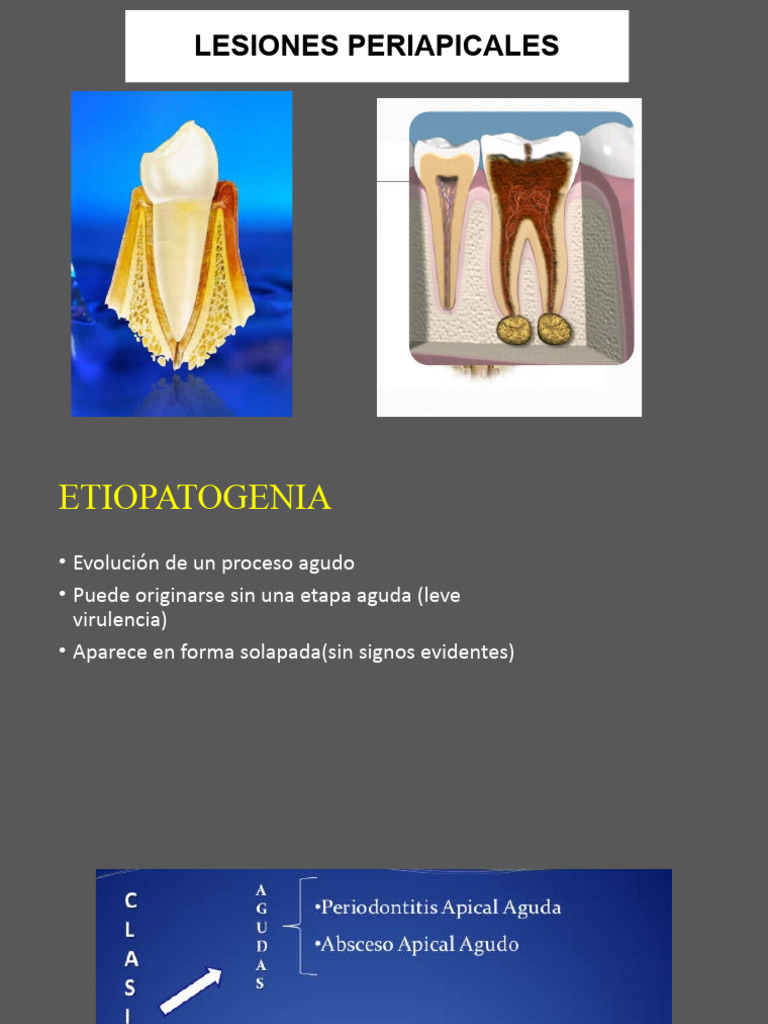 Lesiones Periapicales: Causas y Tipos | PDF