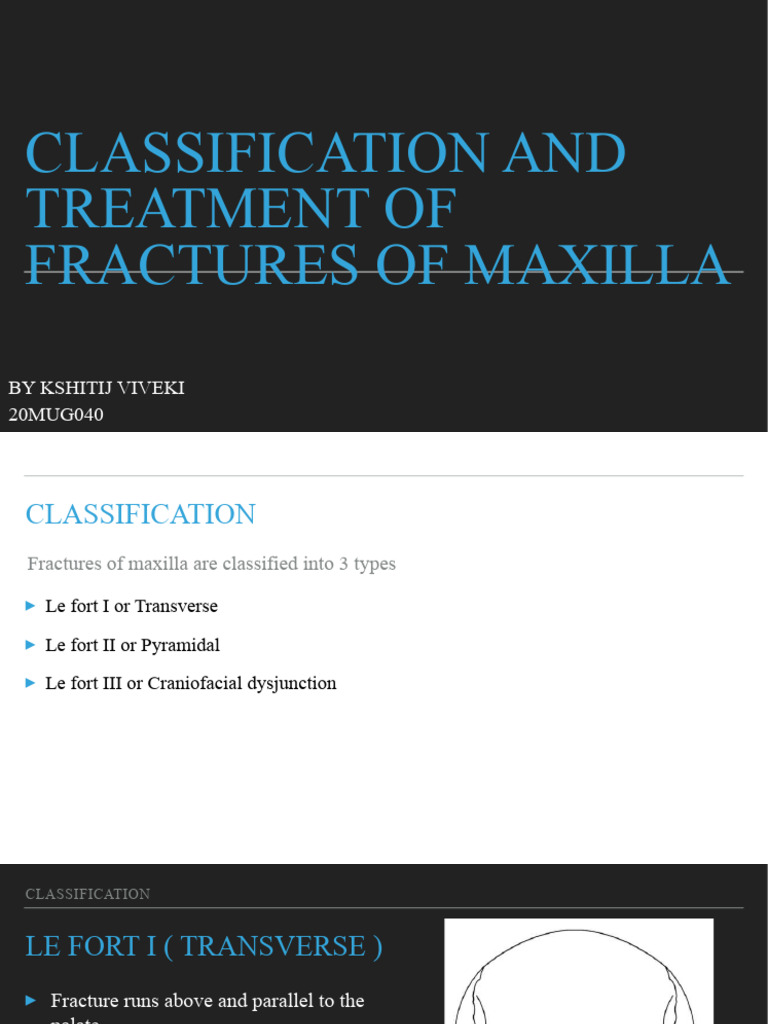 Le Forts Classification | PDF | Human Nose | Anatomy