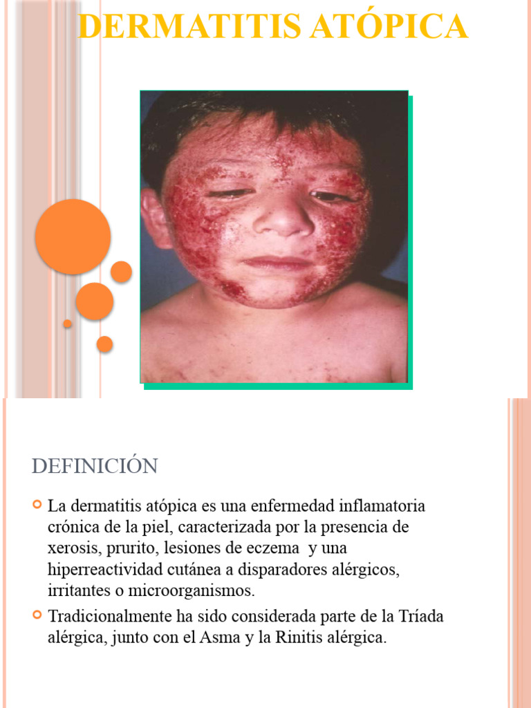 Atopia y Sepsisss para Exponer | PDF | Septicemia | Alergia