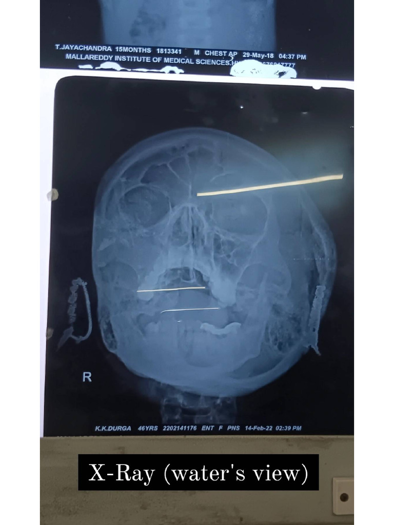 Ent X Rays-0098 | PDF