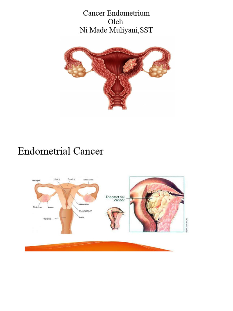 CA Endometrium | PDF