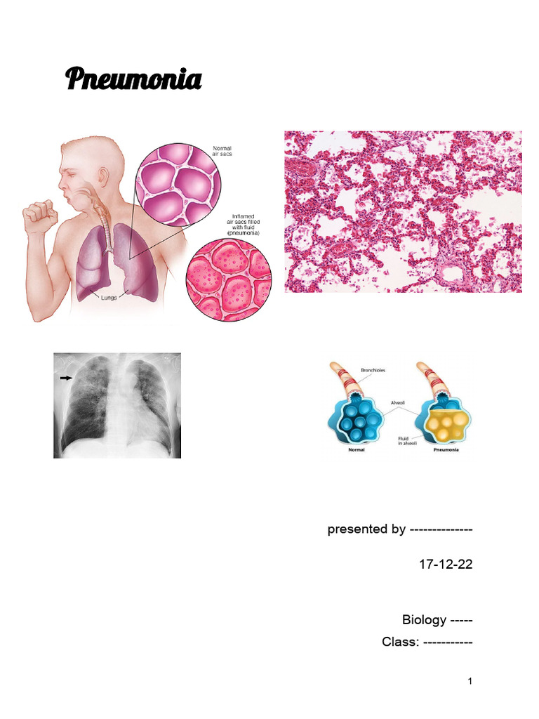 Pneumonia | PDF | Pneumonia | Lung