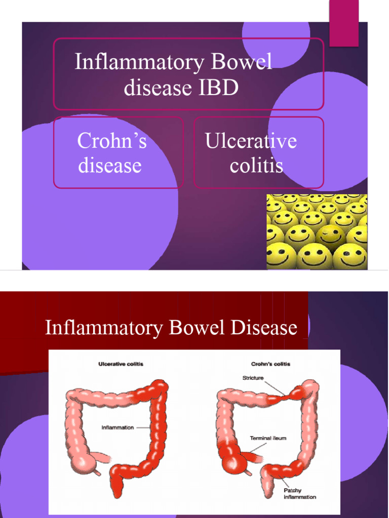 Inflammatory Bowel Disease IBD: Crohn's Disease Ulcerative Colitis | PDF | Ulcerative Colitis ...