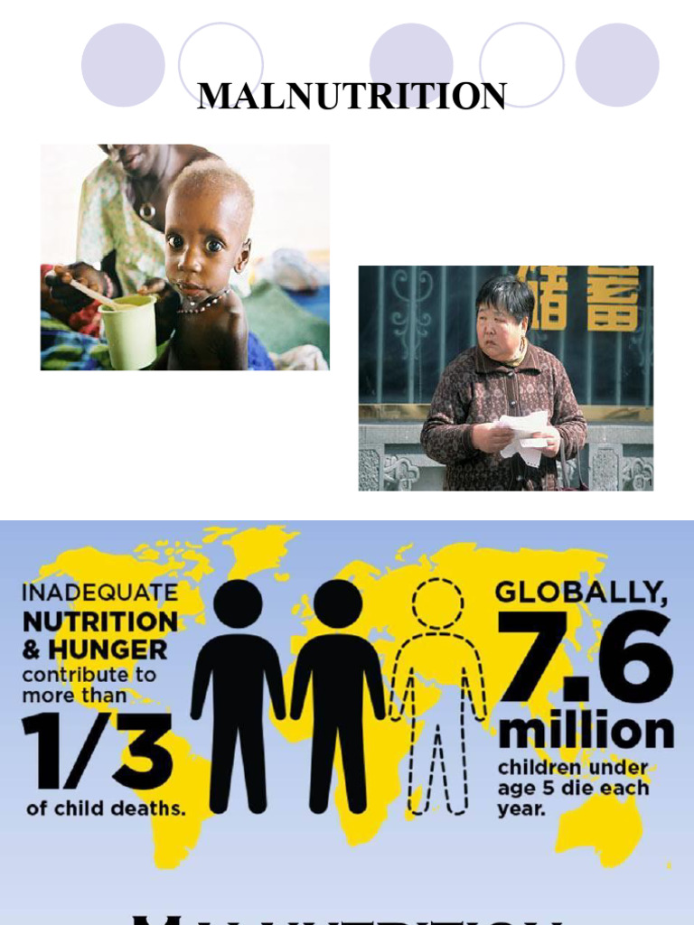 Malnutrition | PDF | Malnutrition | Determinants Of Health