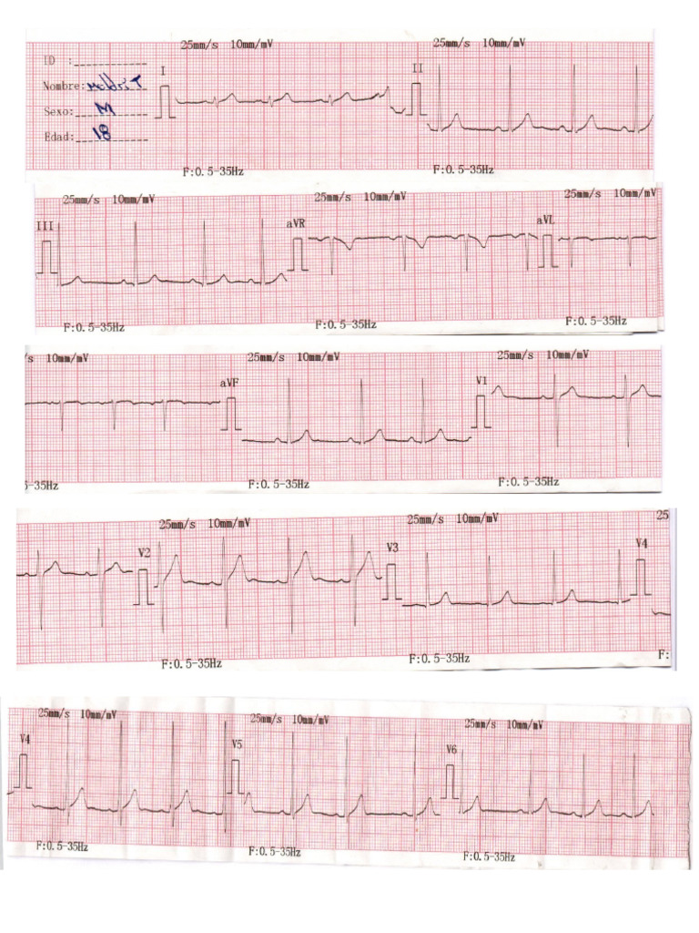 Electrocardiogram A | PDF