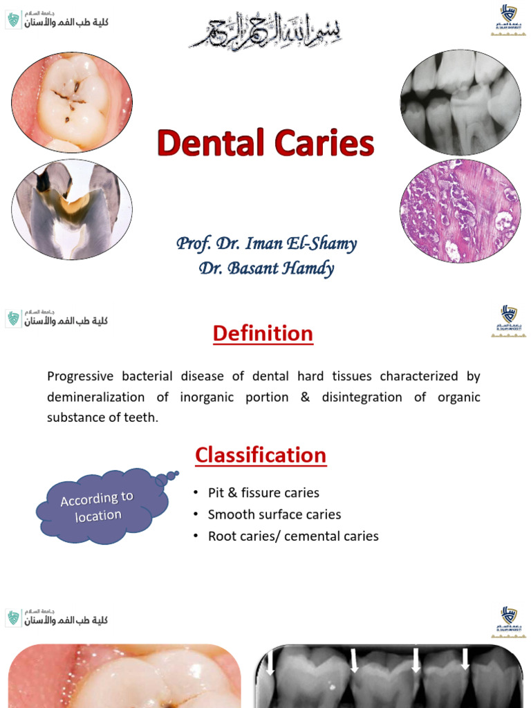 Dental Caries | PDF | Tooth Enamel | Human Tooth