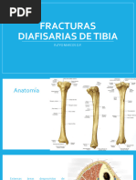 Fractur de Diafisis de La Tibia | PDF | Ct Scan | Hueso