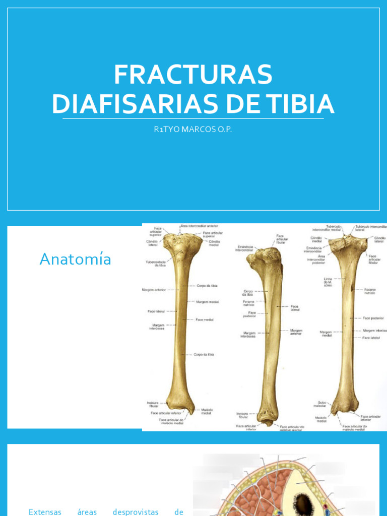 Fracturas Diafisarias de Tibia | PDF | Rodilla | Anatomía humana