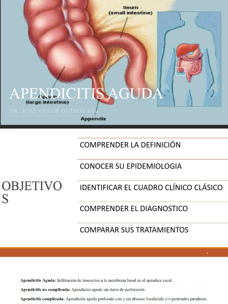 Apendicitis Aguda | PDF | Especialidades Medicas | Medicina CLINICA