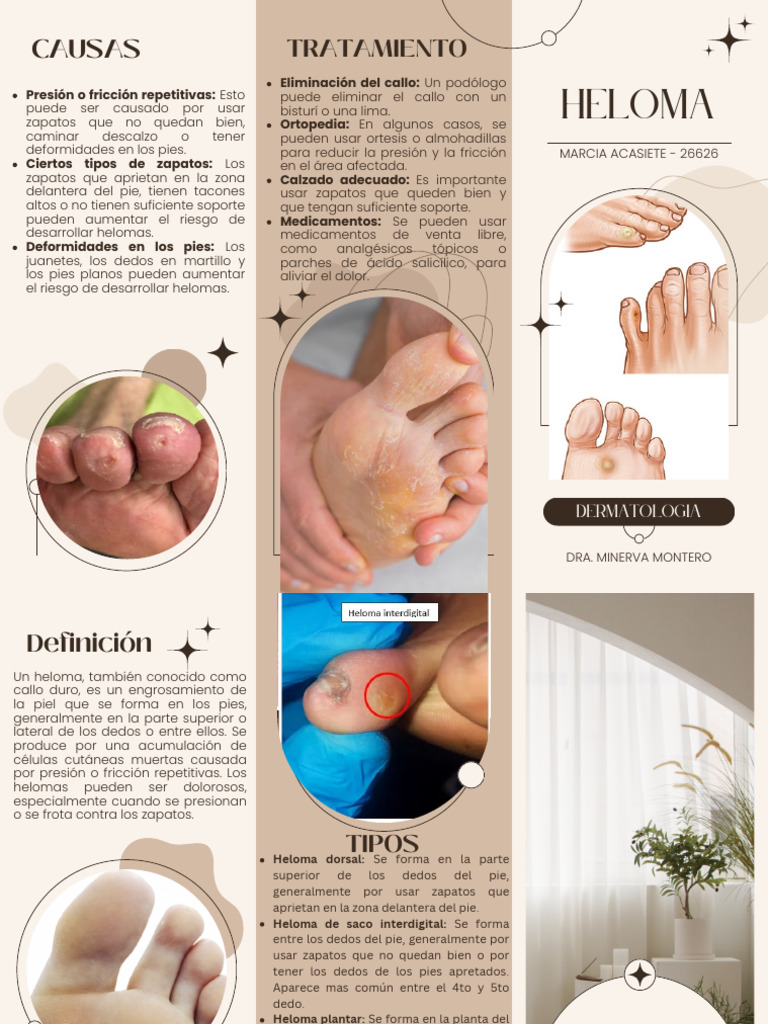 Heloma - Triptico | PDF | Clavo (anatomía) | Pie