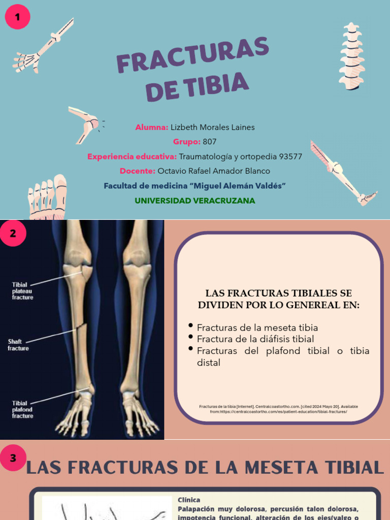 Fractura de Tibia | PDF | Rodilla | Sistema musculoesquelético