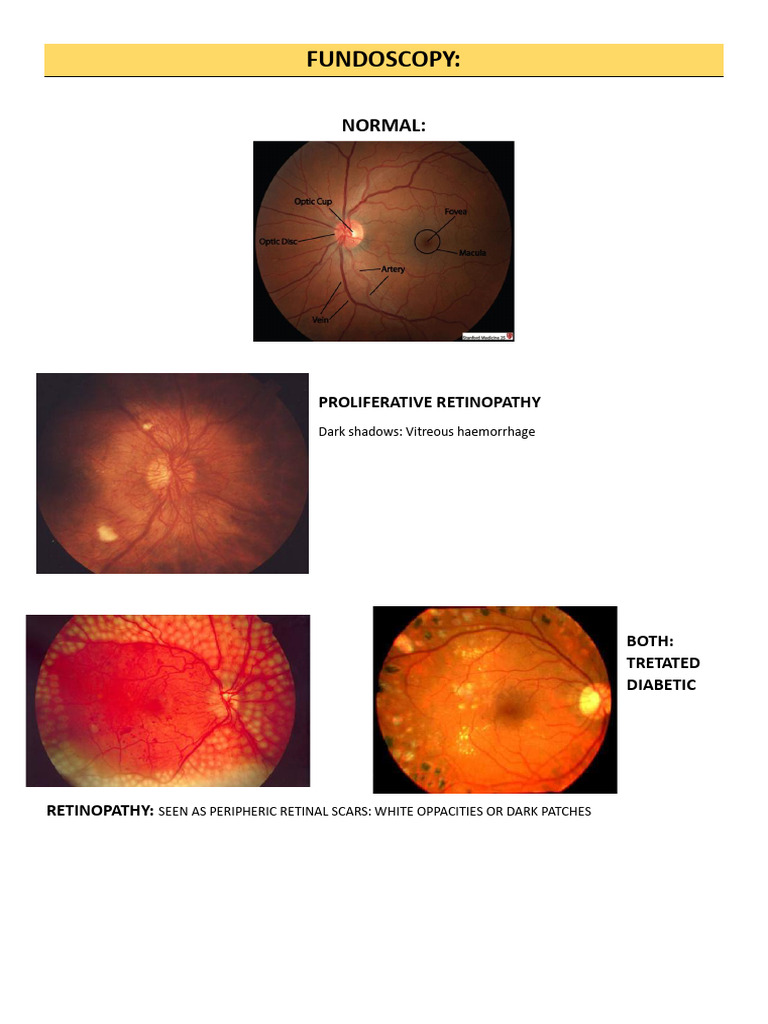 FUNDOSCOPY PLAB | PDF