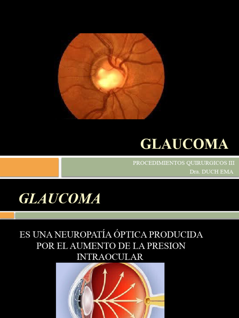 Clase 4 Glaucoma | PDF | Glaucoma | Medicina CLINICA