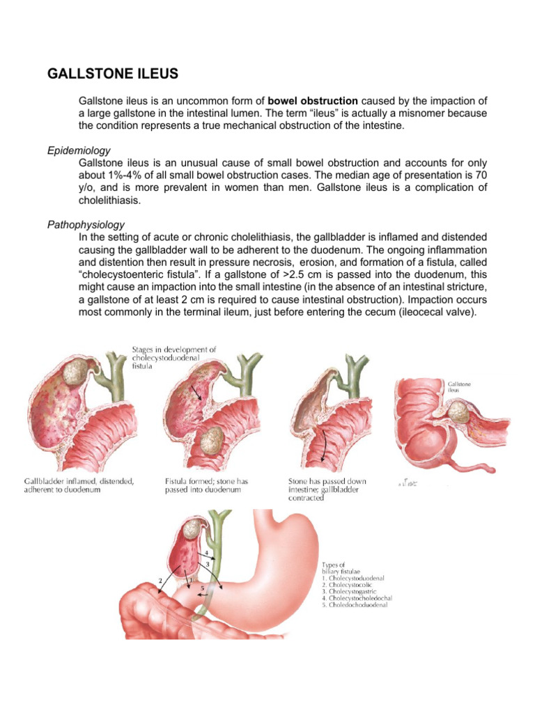 Gallstone Ileus: Diagnosis and Treatment | PDF | Clinical Medicine ...