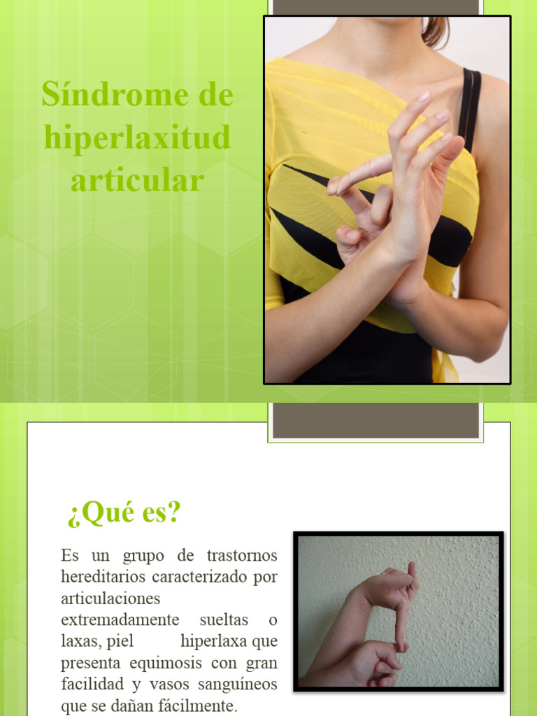 Sindrome de Hiperlaxitud Articular | Descargar gratis PDF | Medicina ...