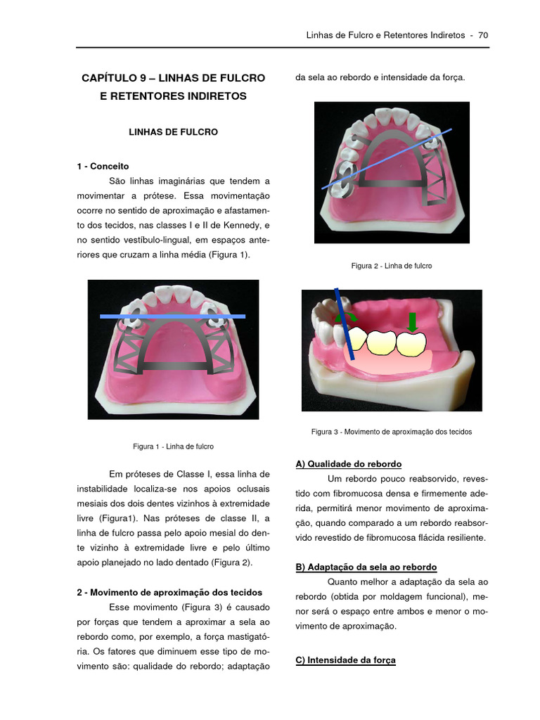 Linhas de Fulcro e Retentores Indiretos | PDF | Dente humano | Prótese