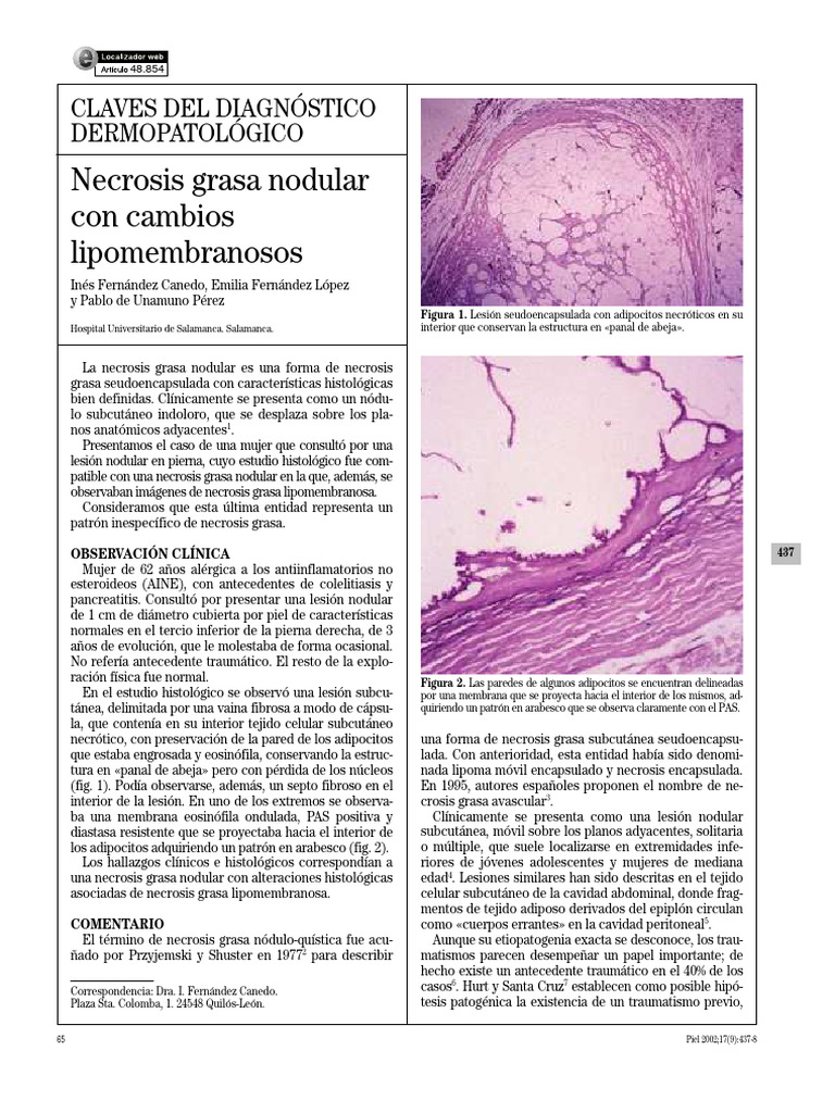 Necrosis Grasa Nodular Con Cambios Lipomembranosos: Claves Del ...
