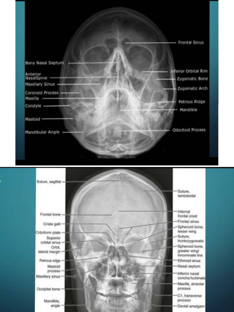 X-Rays - 2nd Year Mbbs Ospe Anatomy | PDF