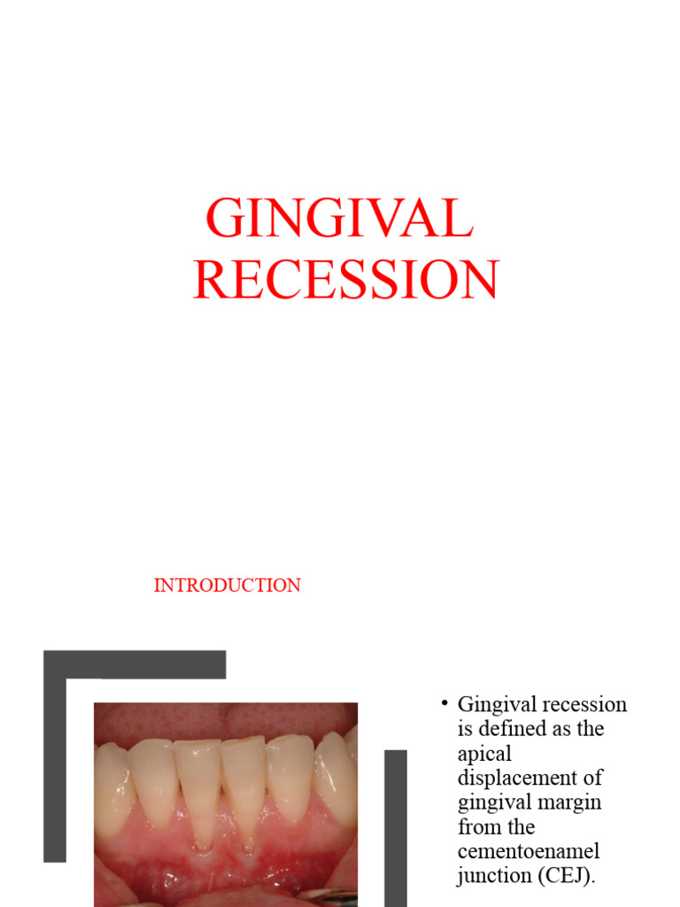 Gingival Recession | PDF | Human Tooth | Tooth