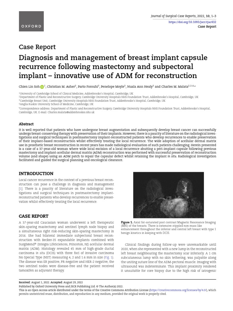 Diagnosis and Management of Breast Implant Capsule Recurrence Following ...