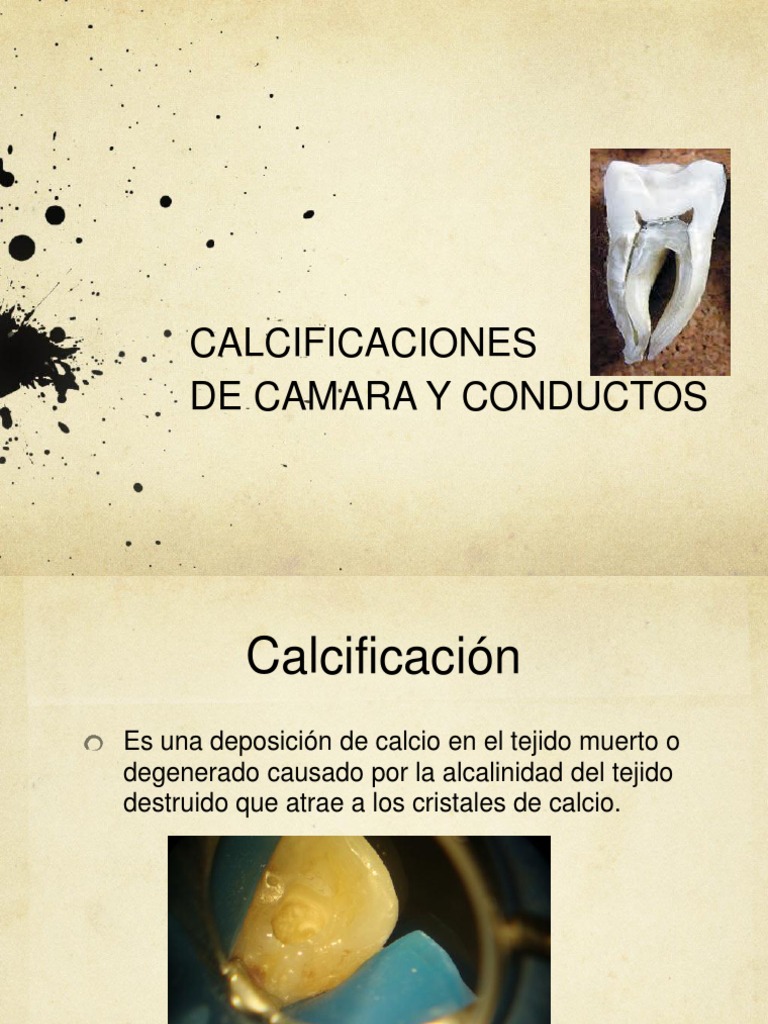 Calcificaciones Pulpares y su Manejo | PDF | Calcio | Diente humano