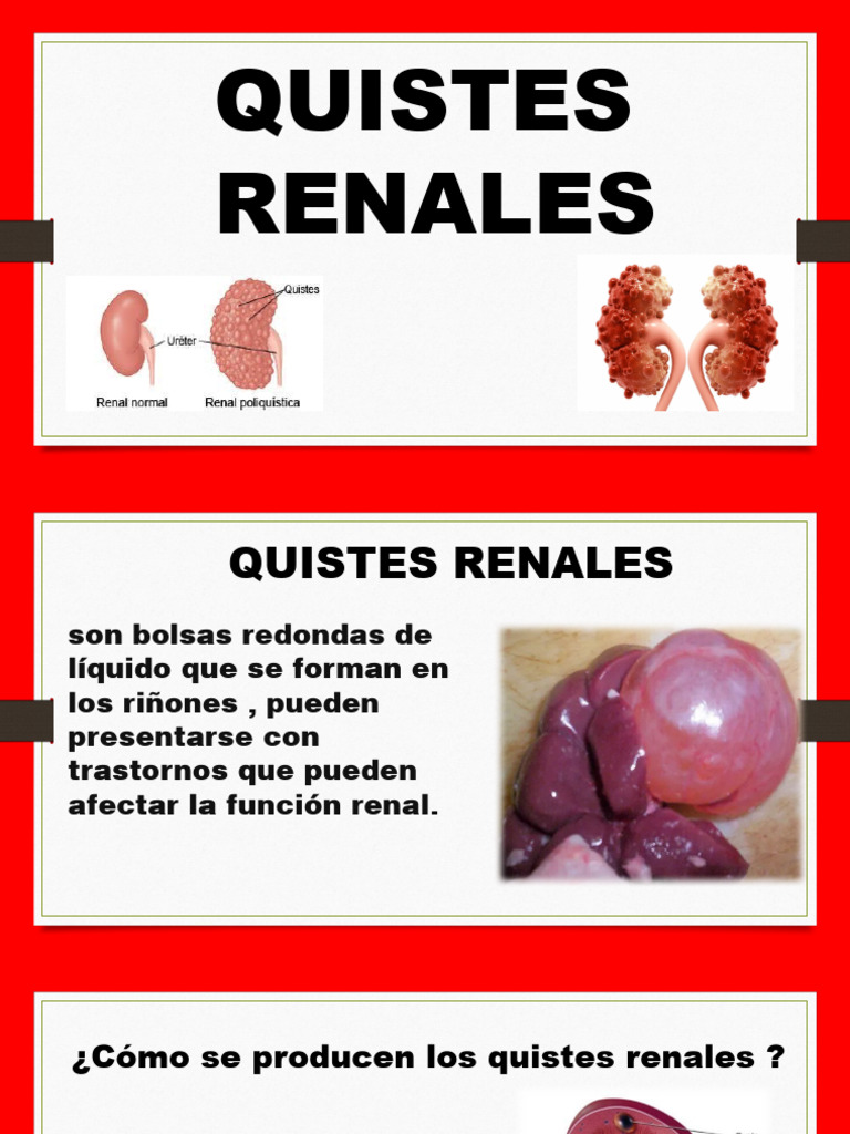 Quistes Renales | PDF