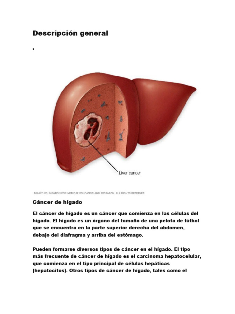 Cancer De Higado Pdf Cáncer Imagen De Resonancia Magnética