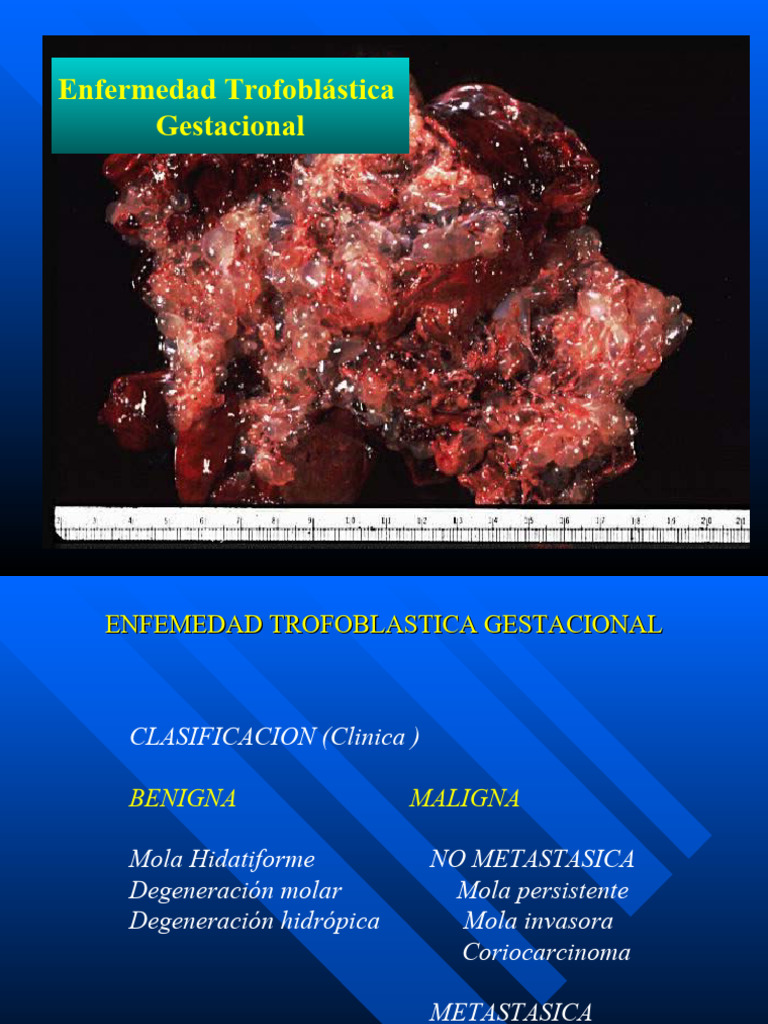 Enfermedad Trofoblastica Gestacional | PDF | El embarazo ...