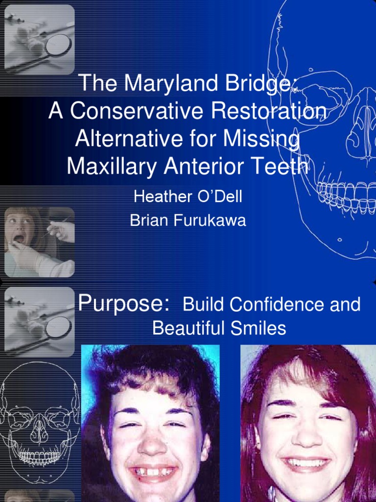 Maryland Bridge Preparation Guide | PDF | Dentistry | Mouth
