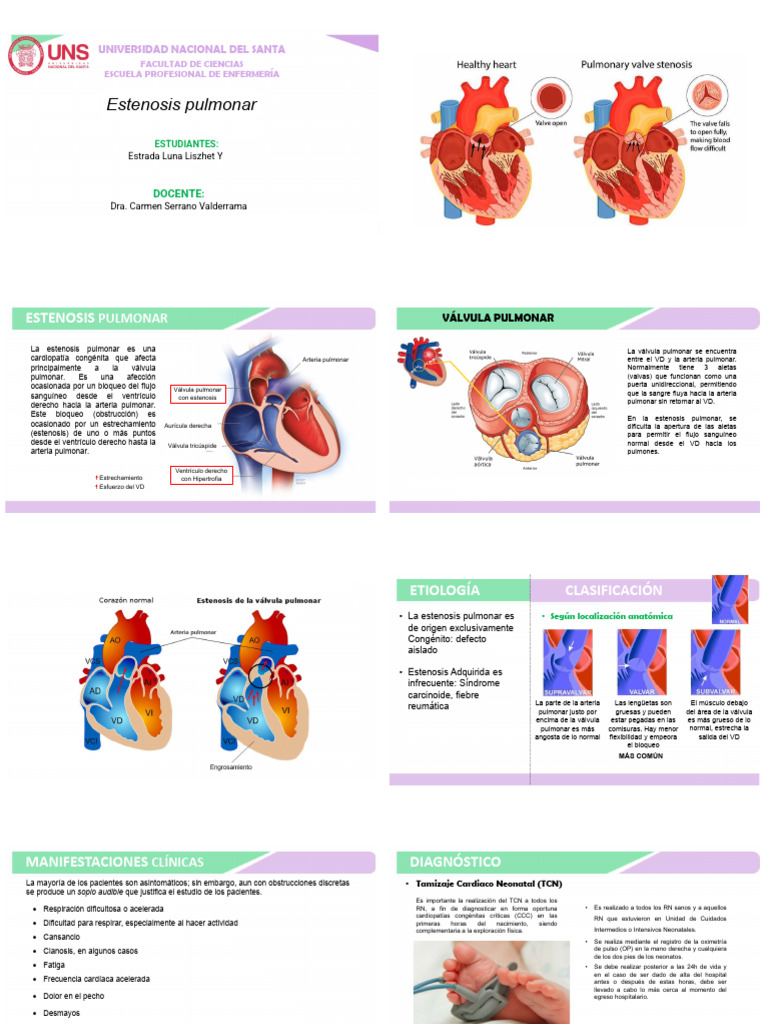 N-Up-Pdf - 5 Estenosis Pulmonar Carmen | PDF | Enfermedades y ...