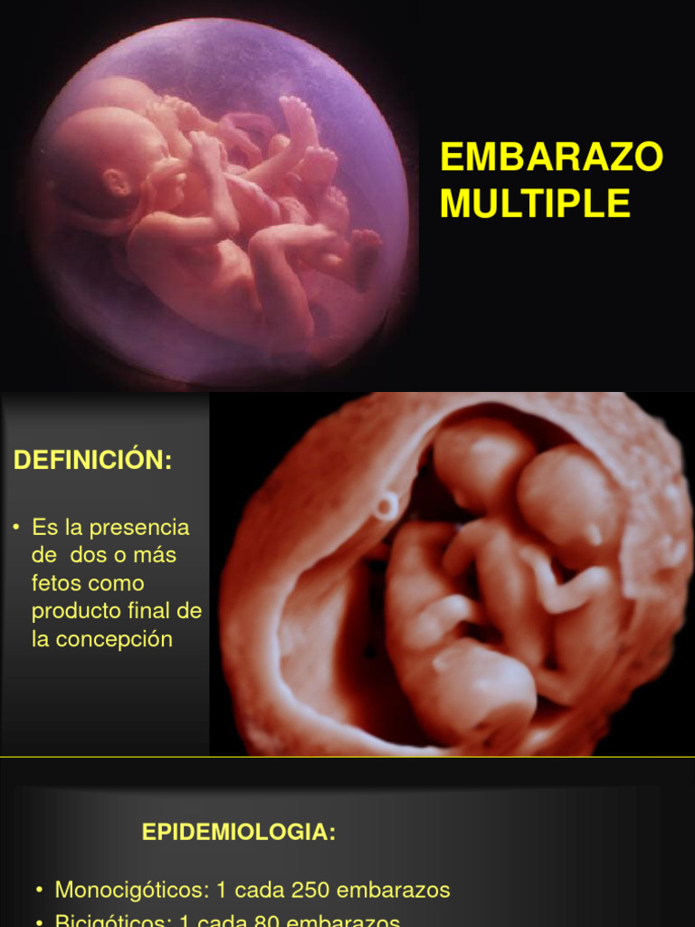 Embarazo Múltiple: Tipos y Complicaciones | PDF | El embarazo | Gemelo