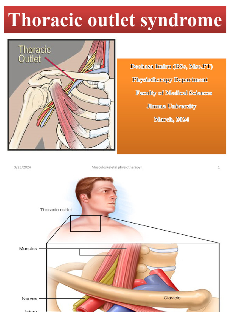 0008 Thoracic Outlet Syndrome | PDF | Diseases And Disorders | Musculoskeletal System