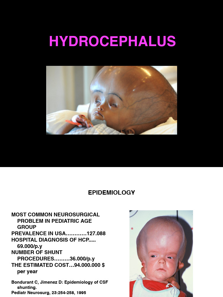 Hydrocephalus | PDF | Cerebrospinal Fluid | Neurology
