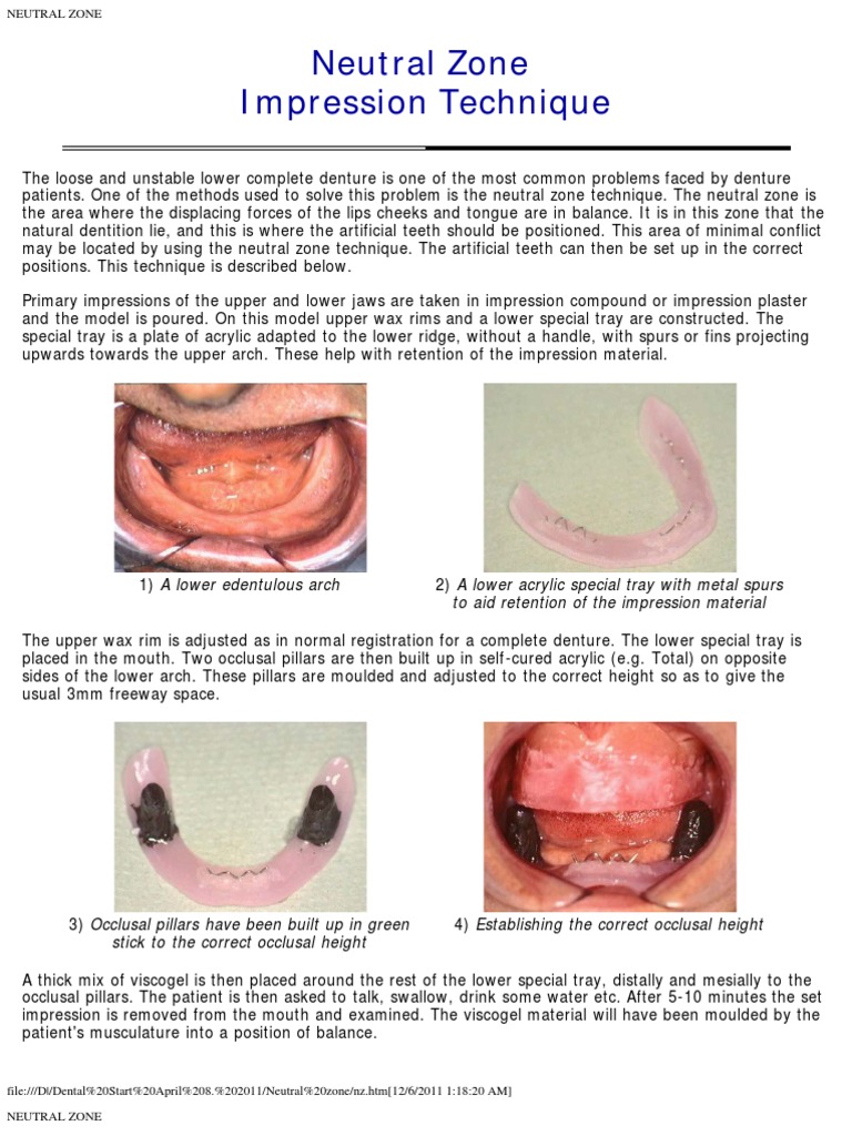 Neutral Zone Impression Technique | PDF | Dentures | Mouth
