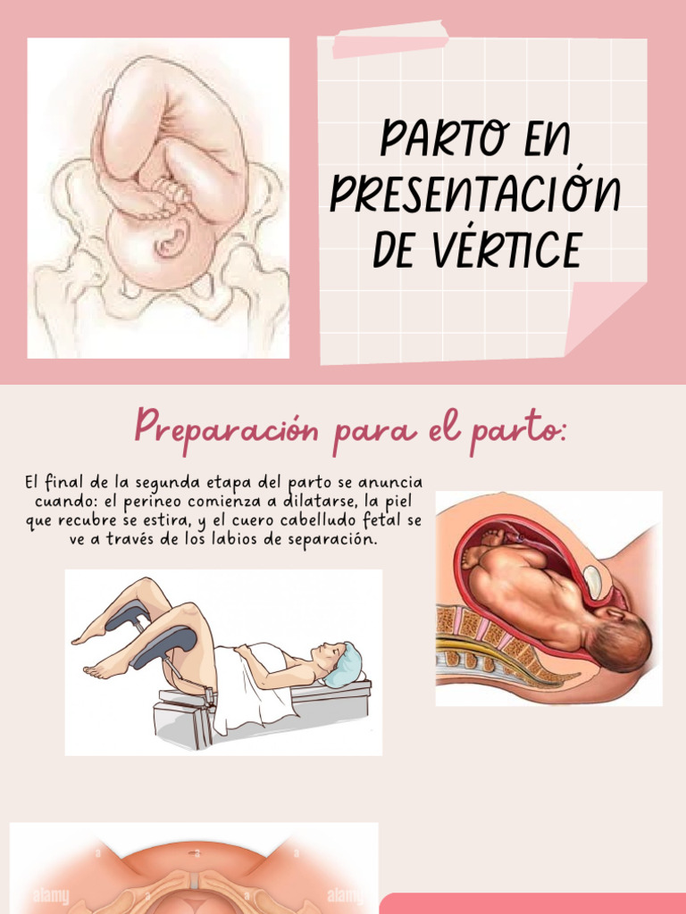 Parto de Vértice | PDF