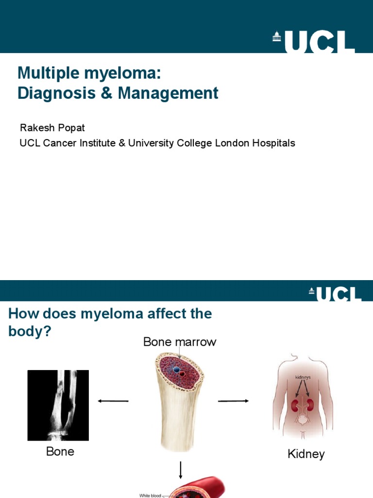 Multiple Myeloma: Diagnosis & Management: Rakesh Popat UCL Cancer ...