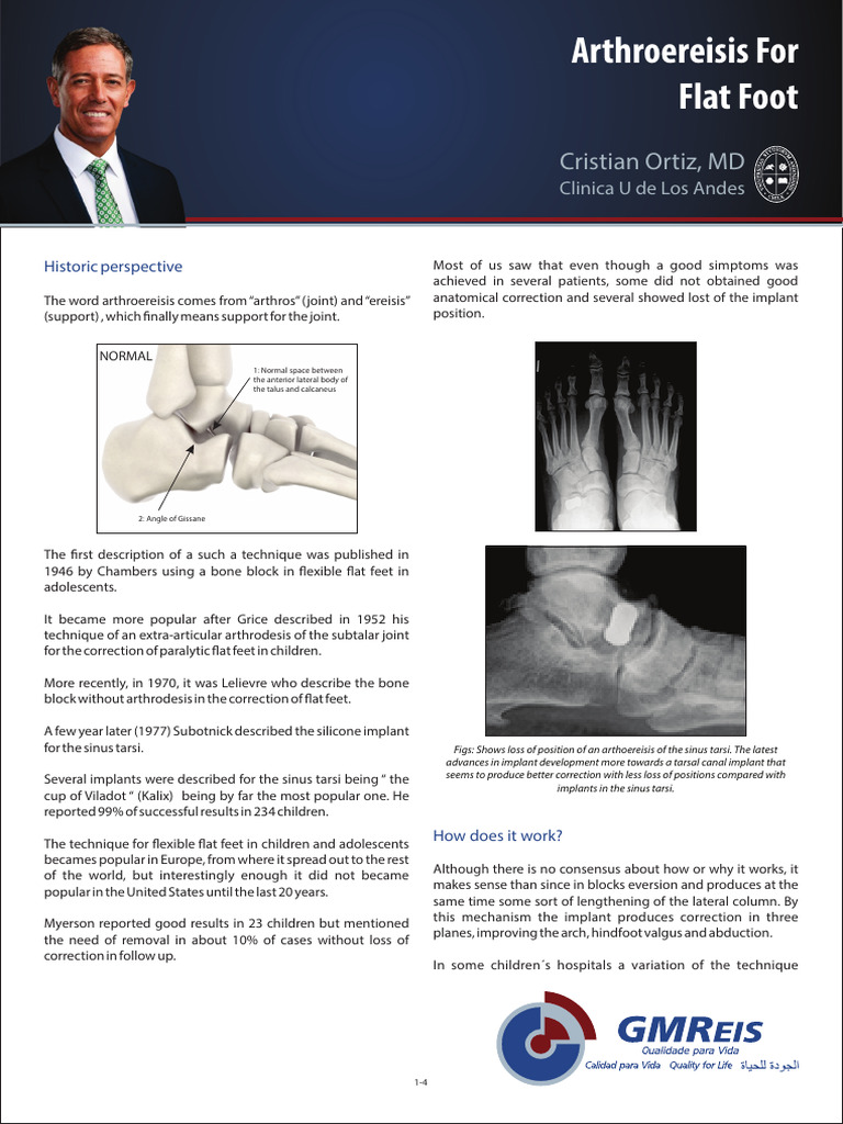 1601671374arthroereisis For Flat Foot | PDF | Foot | Lower Limb Anatomy