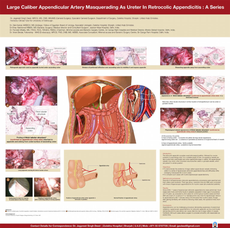 Large Caliber Appendicular Artery Masquerading As Ureter in Retrocolic ...