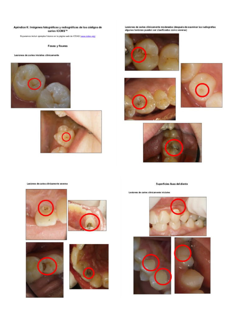 Icdas Dental Pdf