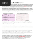 Ventricular Tachycardia - Monomorphic VT - LITFL | PDF ...