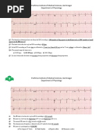 Left Anterior Fascicular Block (LAFB) - LITFL - ECG Library Diagnosis ...