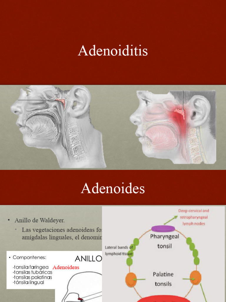 1) Adenoiditis y Amigdalitis | PDF | Alergia | Enfermedades y trastornos
