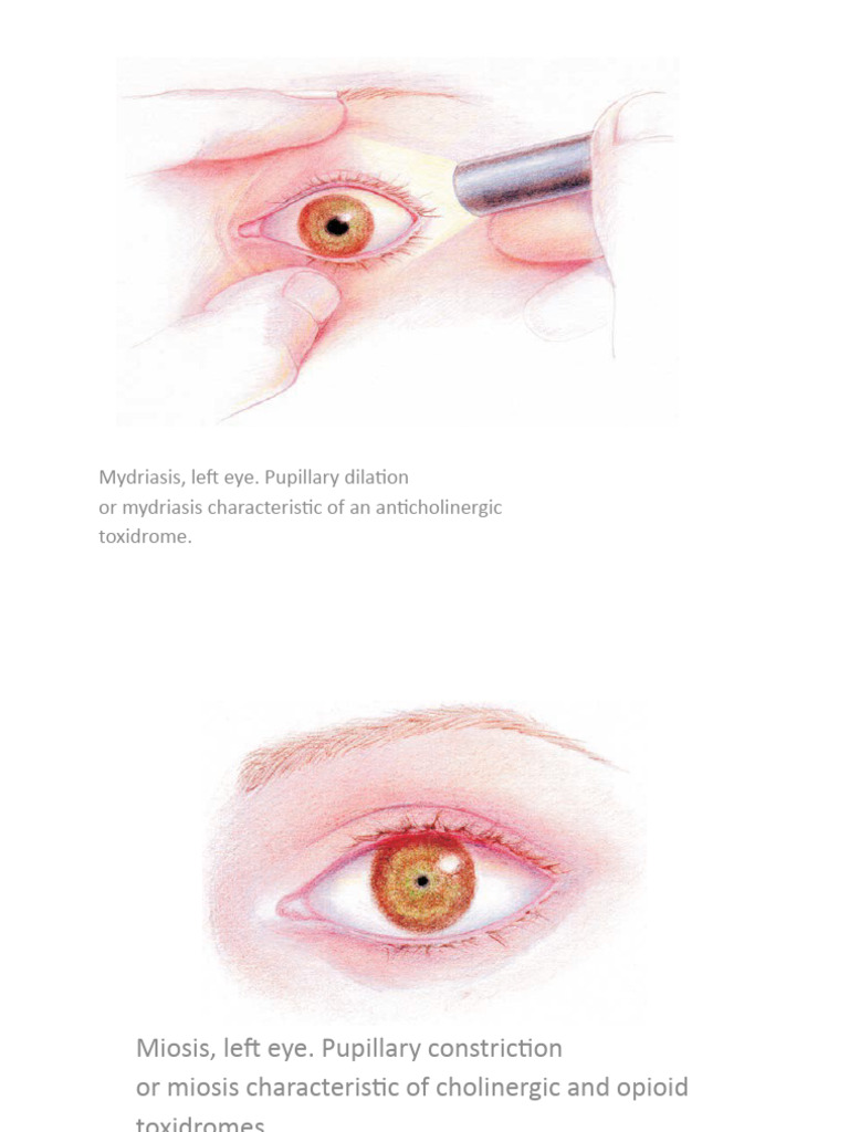 Mydriasis and Miosis-1 | PDF