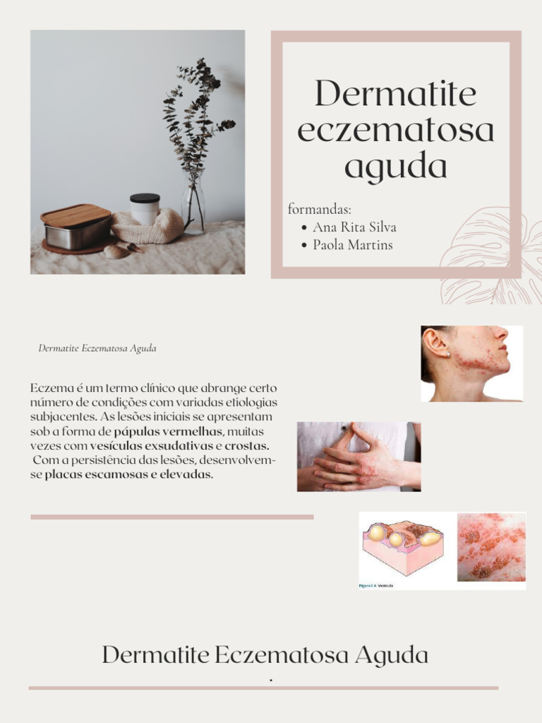Dermatite Eczematosa Aguda | PDF | Dermatite | Doenças e distúrbios
