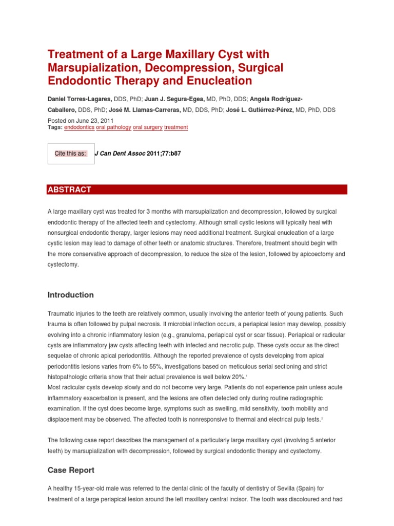 Treatment of a Large Maxillary Cyst With Marsupialization | Surgery | Mouth
