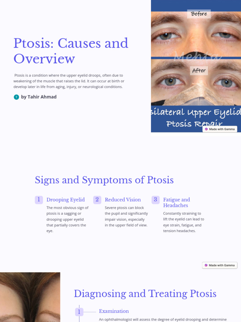 Ptosis Causes and Overview | PDF | Ophthalmology | Diseases And Disorders